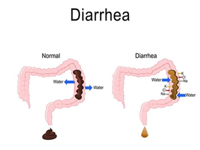 İshal (Diyare) – Gastroenteroloji Doktoru Endoskopi kolonoskopi ...